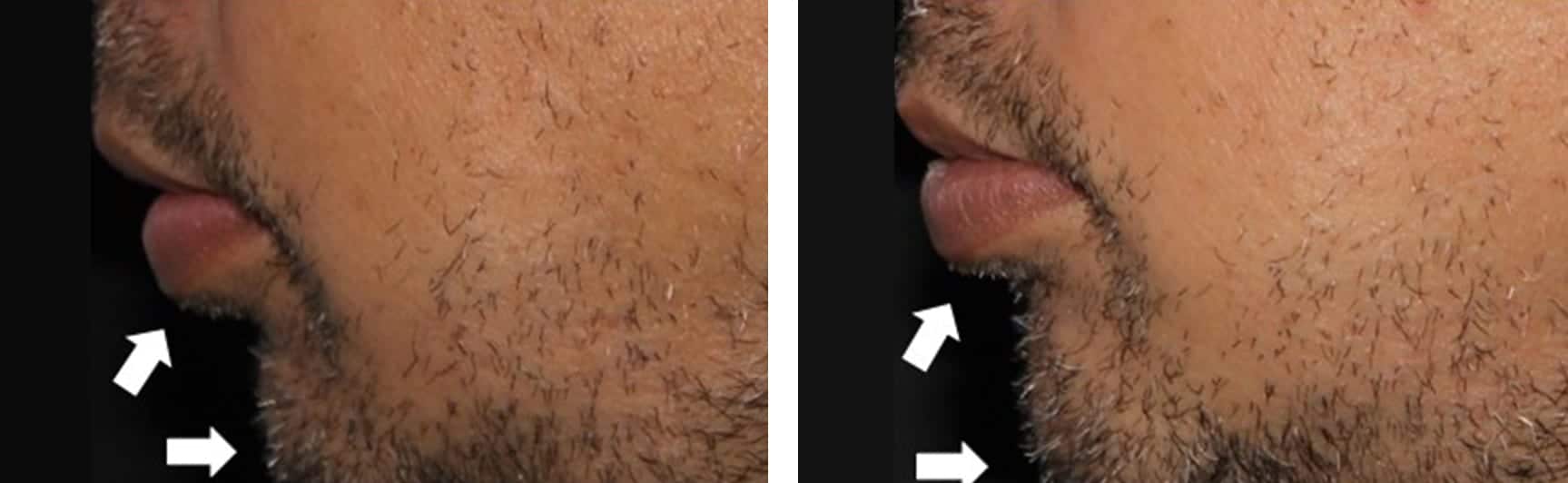 Weak Chin Treatment Dermal Fillers At Define Medical Clinic Beaconsfield weak-chin-treatment-dermal-fillers-at-define-medical-clinic-beaconsfield