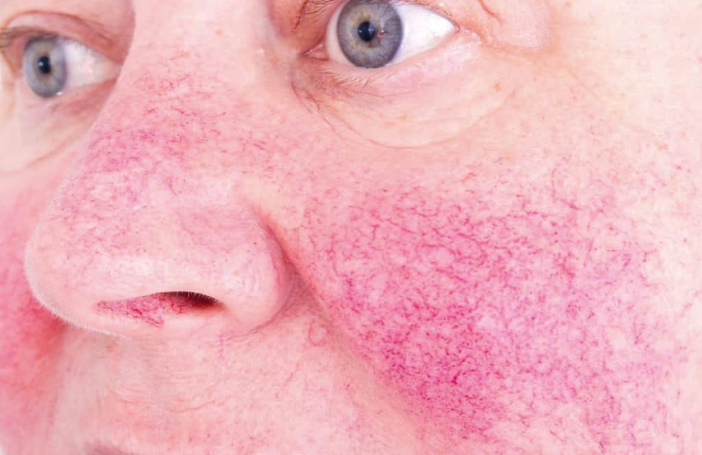 Facial Veins Treatment with IPL Laser at Define Medical Clinic Beaconsfield