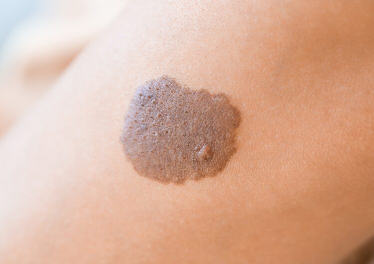 Define Clinic: Expert Birthmark Removal Services Offered