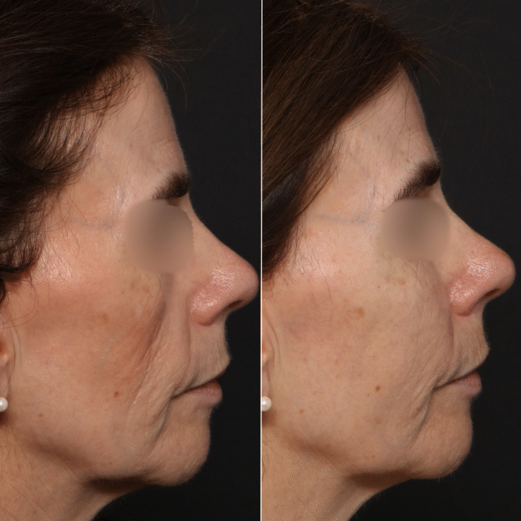 Cheek Fillers Treatment Available at Define Clinic