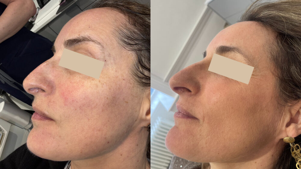 Sciton HALO Treatment Available at Define Clinic
