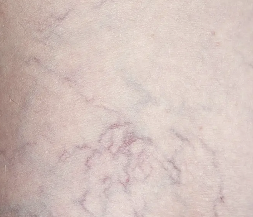 Facial Thread Veins Treatment Options at Define Clinic