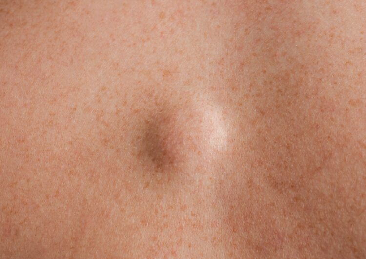 Lumps & Bumps | Define Clinic London & Beaconsfield